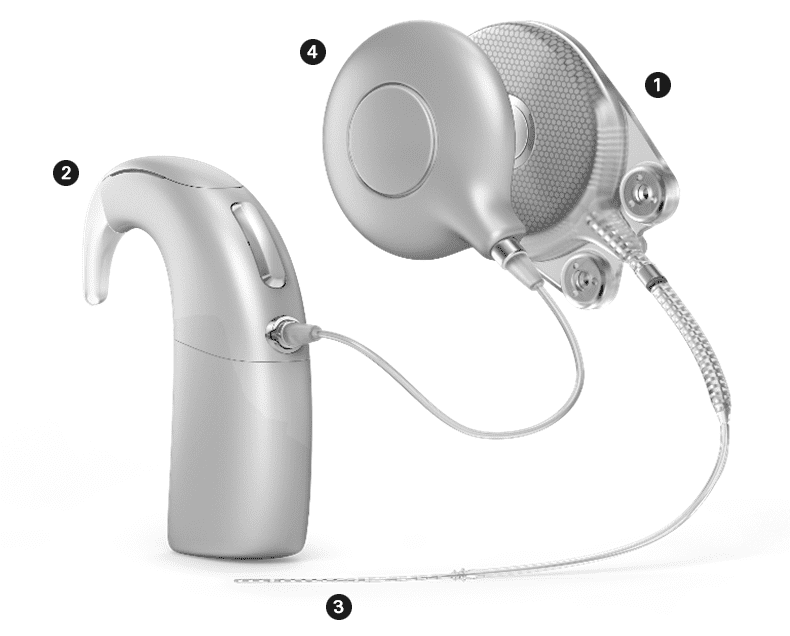 cochlear implant device